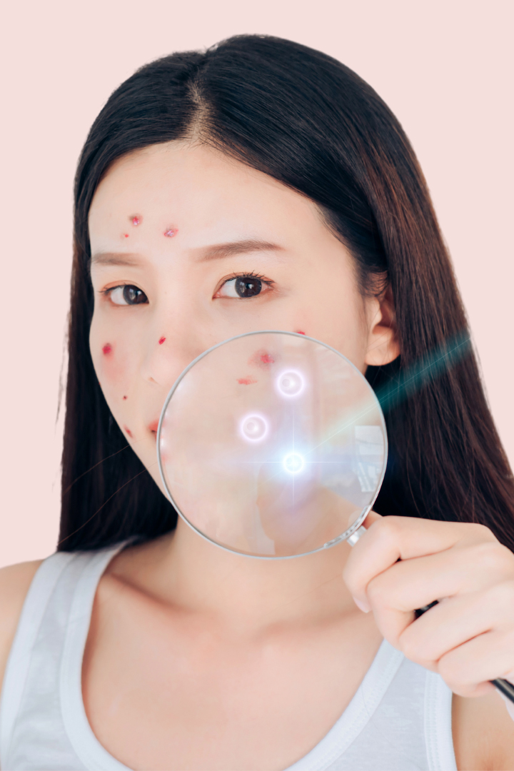 Acne-Prone – greenika.ph